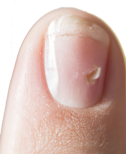 Nail Health: Problems, Causes, and Treatment - HealthNormal
