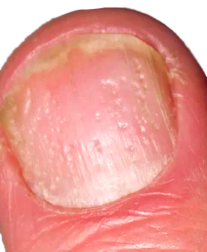 Nail Health: Problems, Causes, and Treatment - HealthNormal