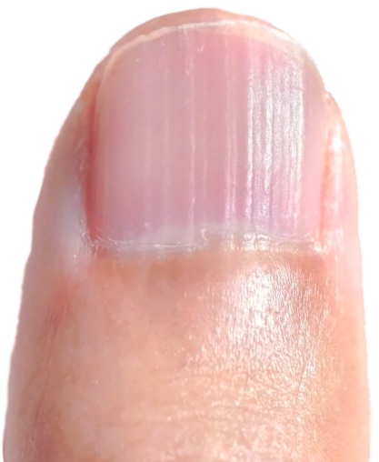 Nail Health: Problems, Causes, and Treatment - HealthNormal